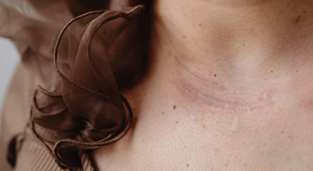 Scar Camouflage FAQs - BeautyInk By Leanne